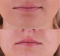 Botox Edmonton, Injectables & Dermal Fillers | Hemingway